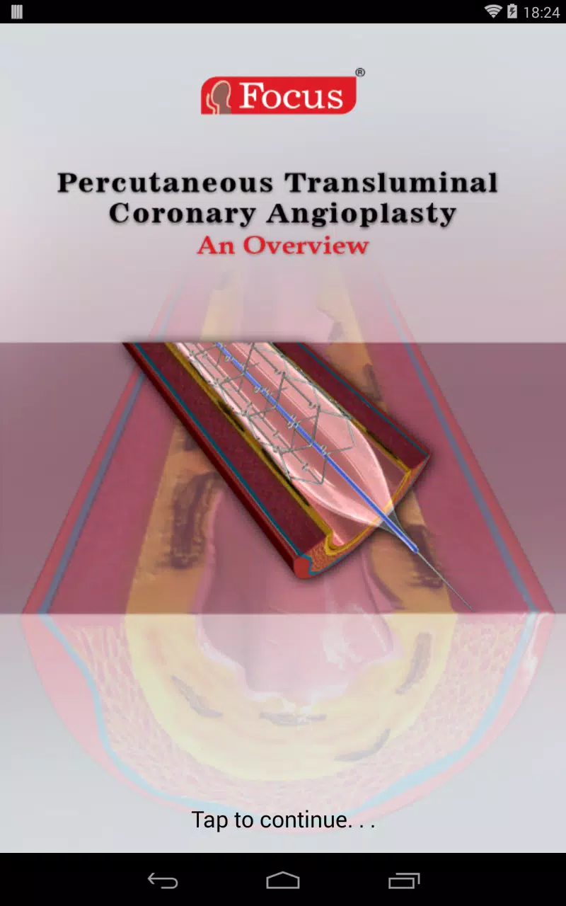 Percutaneous Transluminal Coronary Angioplasty (ptca)