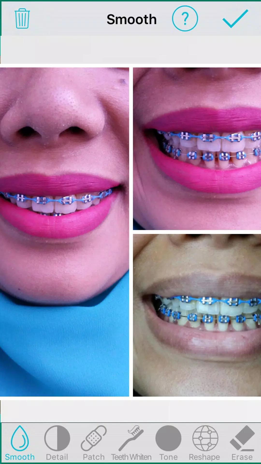 Pretty Braces Color Combinations