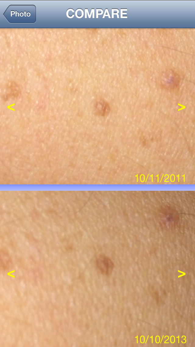 Skin Prevention – Photo Body Map for Melanoma and Skin Cancer early ...
